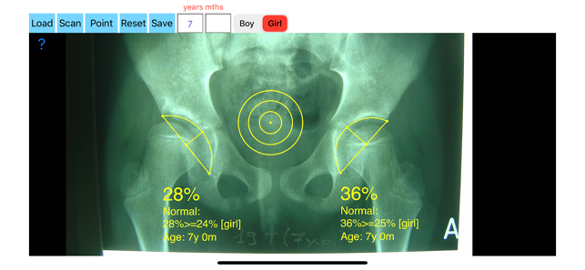 ‎App Store에서 제공하는 AcetabularDepthRatioApp