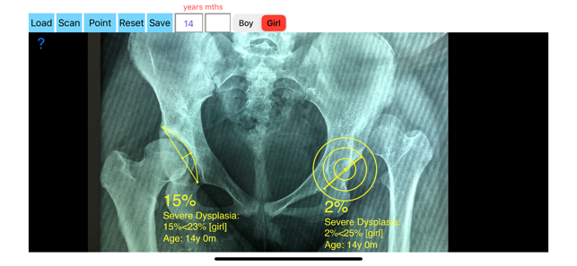 ‎App Store에서 제공하는 AcetabularDepthRatioApp