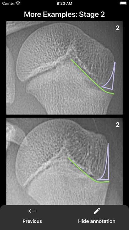 What's the Skeletal Maturity? by Raymond Liu